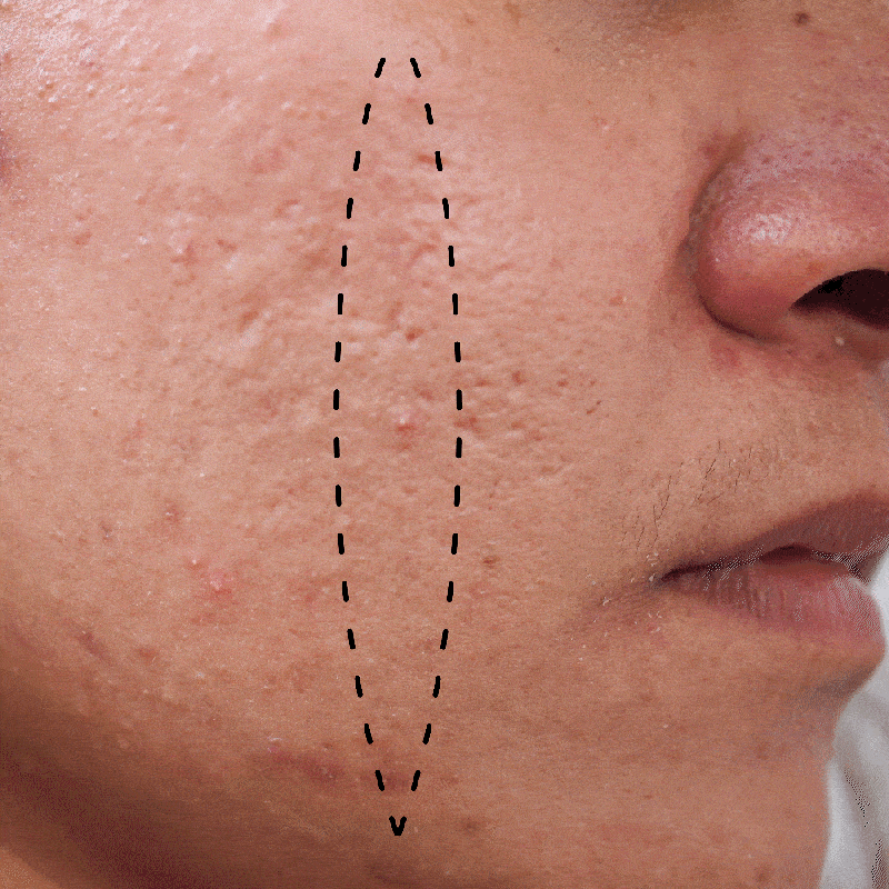 Unlocking the Collagen Boost: Microneedling for Scar Reduction
